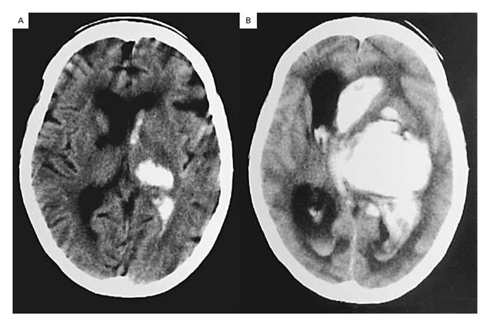 Dentistry and Medicine: Cerebrovascular Accident