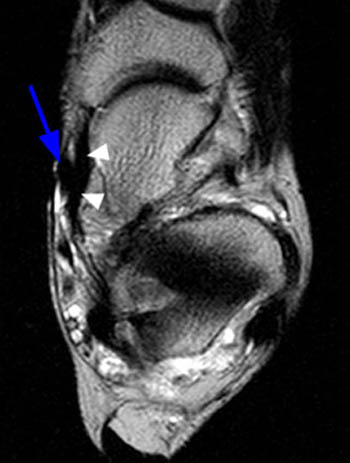 MRI Musculo-Skeletal Section: Spring complex ligament.