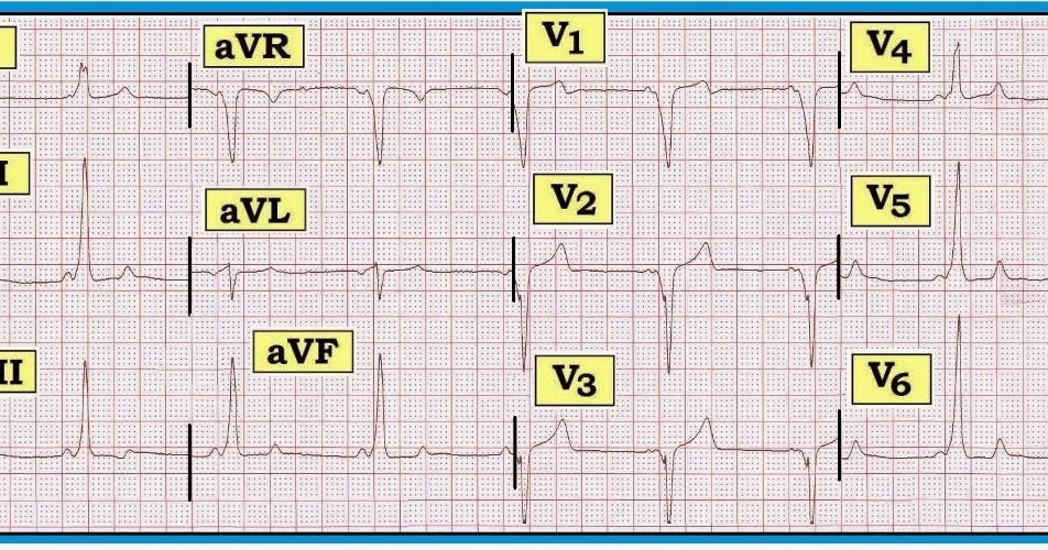 ECG Interpretation: ECG Interpretation Review #76 (Anterior Infarction ...