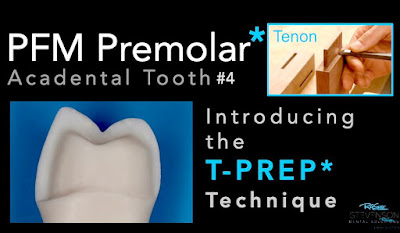 PROSTHODONTICS: PFM Premolar T-PREP - Dr. Richard Stevenson