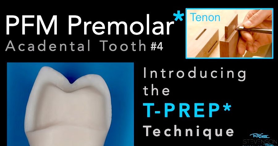 PROSTHODONTICS: PFM Premolar T-PREP - Dr. Richard Stevenson - Odonto-Tv