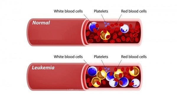 Cancer Treatment Breakthrough: Scientists Have Found a Method to Make ...