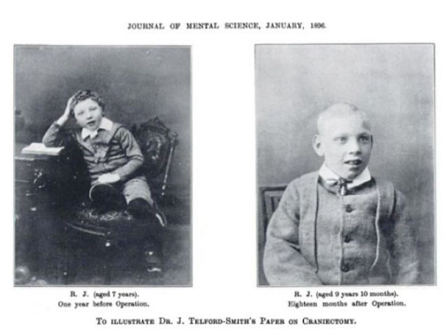 Do You Need a Lobotomy? Just Look at the Results From These Before and ...