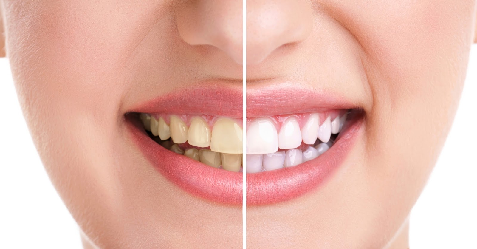 Teeth Whitening - Bleaching ~ Dr. Bharat Katarmal Dental & Implant Clinic