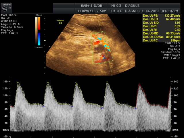 Jhoanna: Ecografia Doppler Obstetrica