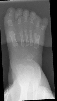 Extra Digits | Congenital Hand and Arm Differences | Washington ...