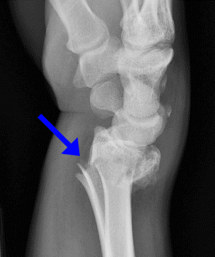 Fracture/Dislocation/Sublaxation ~ Anatomy for MSP