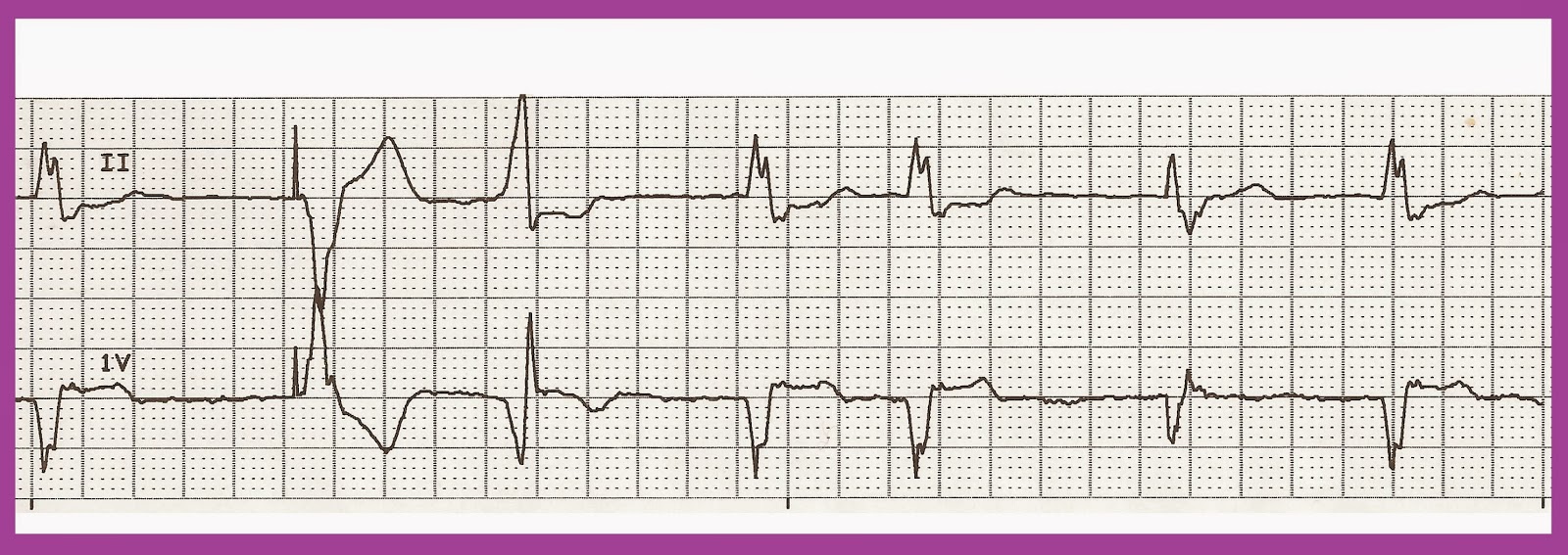 EKG Rhythm Quiz 232