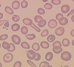 FICHERO DE HEMATOLOGIA: ALTERACIONES ERITROCITARIAS
