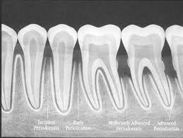 Crystal Lake Dental's Hot topics: Dental X-rays and Mengioma (Brain ...