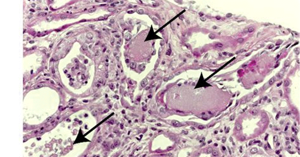 Nephron Power: IN the NEWS: Vancomycin induced CAST nephropathy