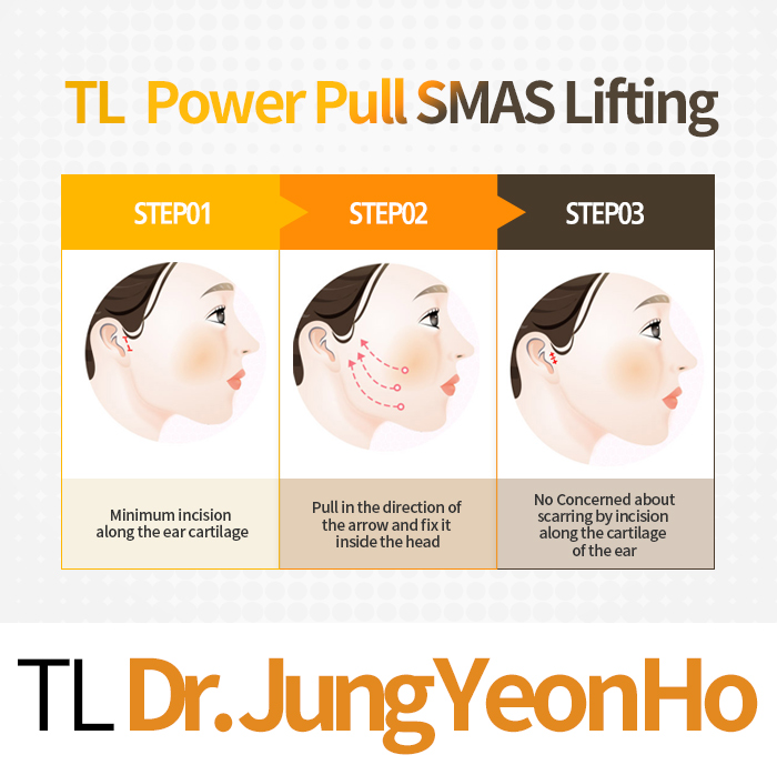 SMAS FACELIFT - TL ANTI-AGING LIFTING KOREA