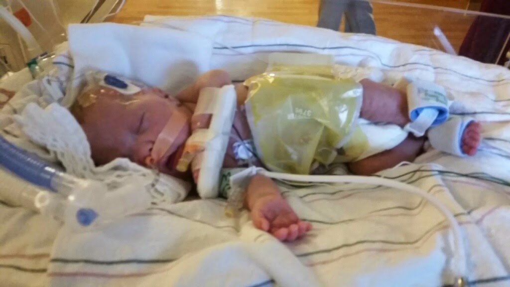 Natalie Rose - Daily Update of our Micro Preemie: PDA Ligation Surgery ...