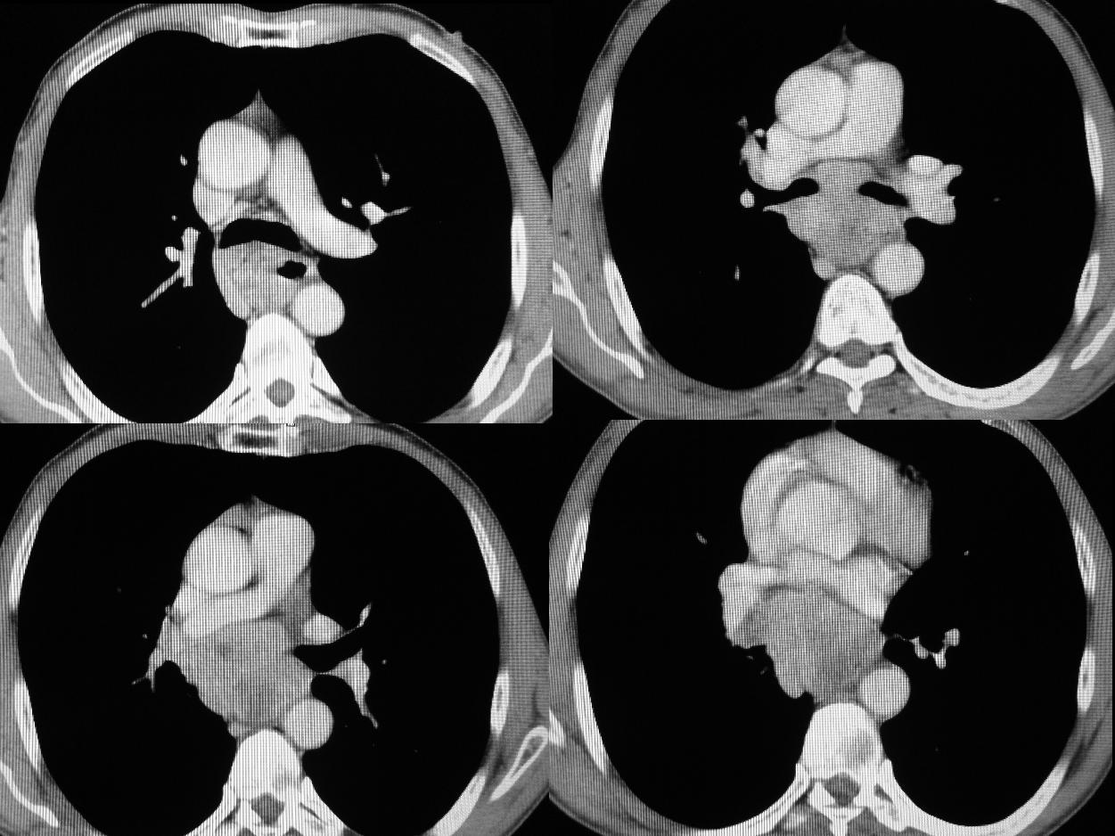 ENDOSCOPIA TERAPEUTICA Día a Día: Neoplasia del esófago - USE y Prótesis.