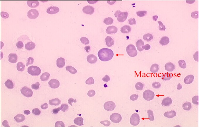 Les Anémies macrocytaires - BIOLOGIE MEDICALE