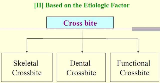 Dentistry lectures for MFDS/MJDF/NBDE/ORE: Etiology, Classification ...