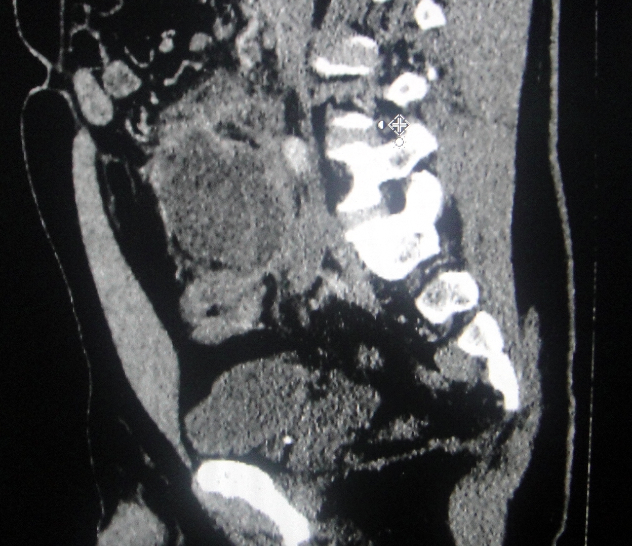 VIETNAMESE MEDIC ULTRASOUND: CASE 150: PERIUMBILICAL MASS, Dr PHAN ...