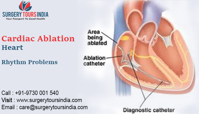 Cardiac Ablation for Heart Rhythm Problems