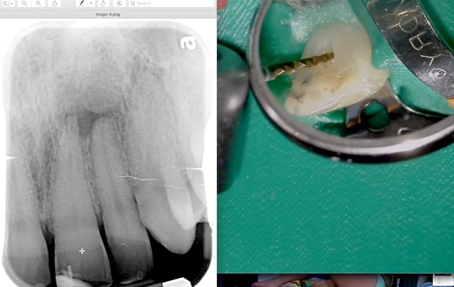 Endodontics Root Canal Orifice Openers And Torsional Fatigue Vtaper