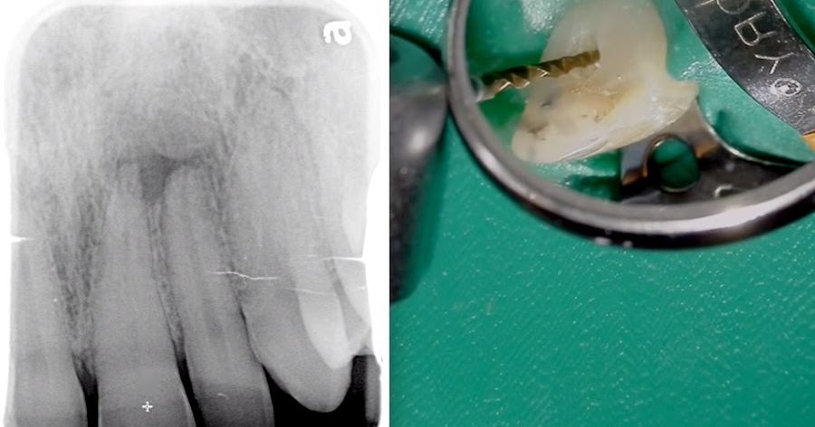 ENDODONTICS: Root Canal Orifice Openers and Torsional Fatigue - VTaper ...