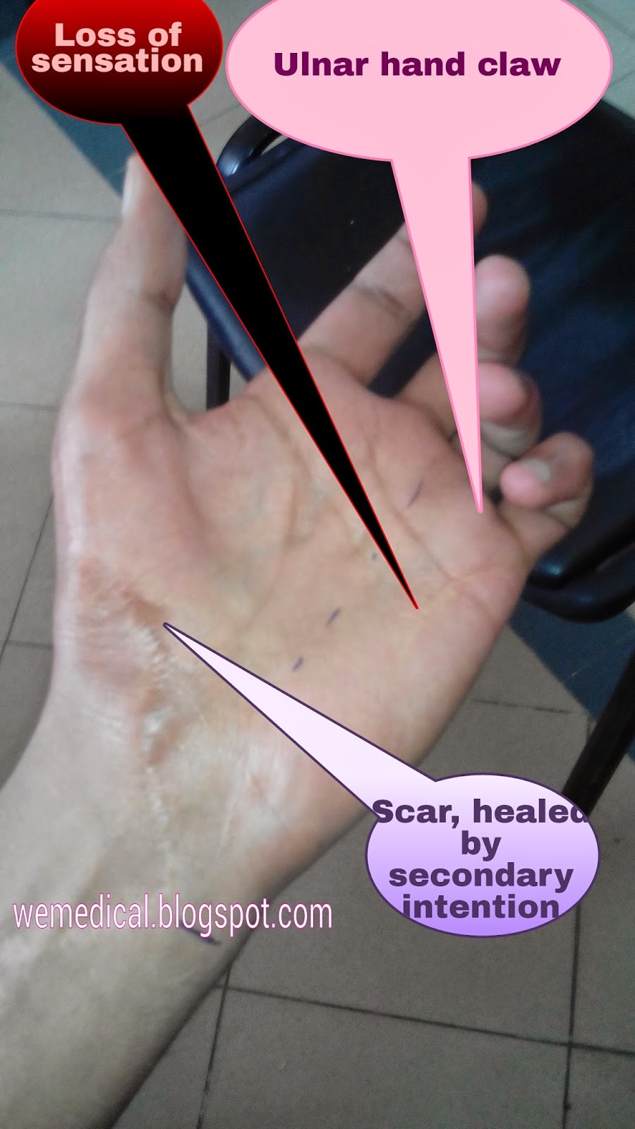 Ulnar Claw Hand; | Wemedical