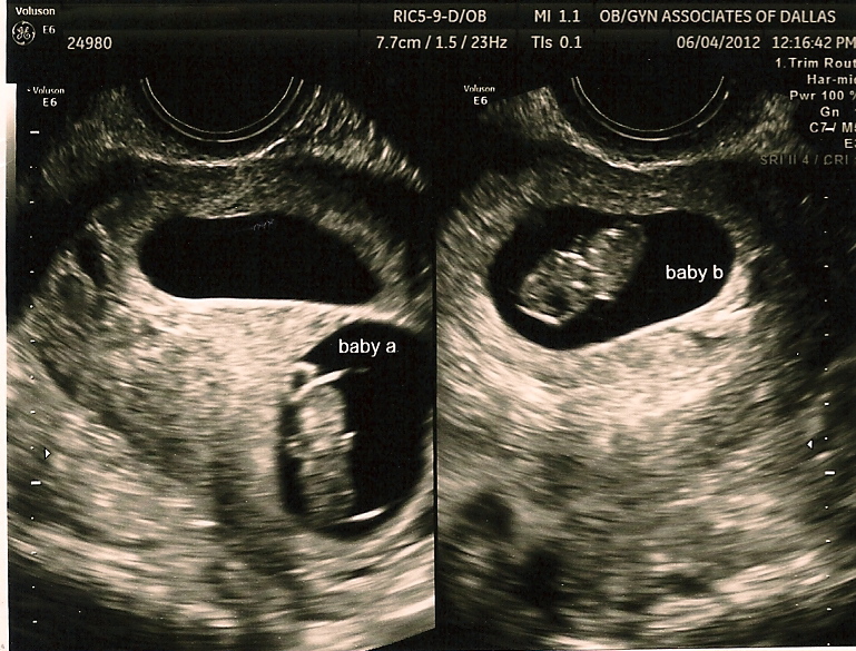 Syringe Sisters: Subchorionic Hematoma