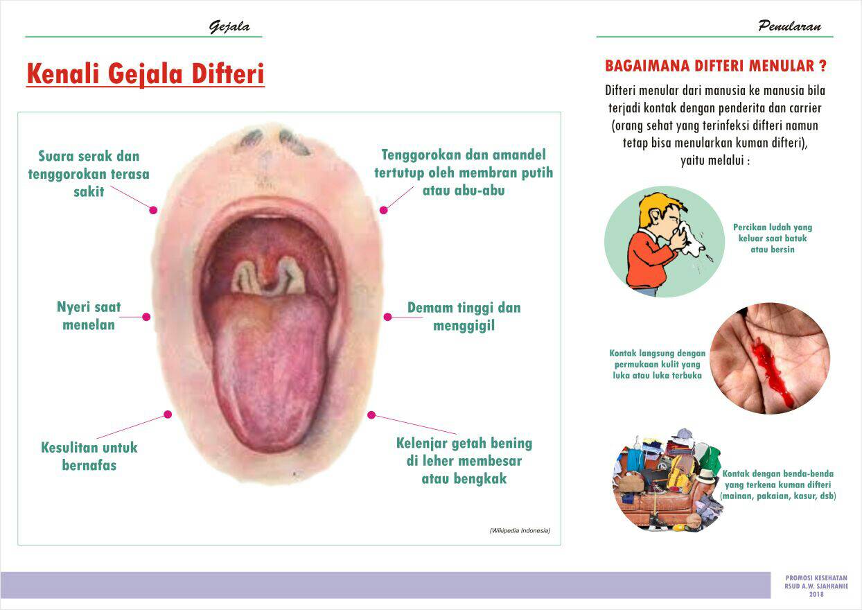 Pengertian difteri, penyebab dan cara penanganan secara lengkap ...