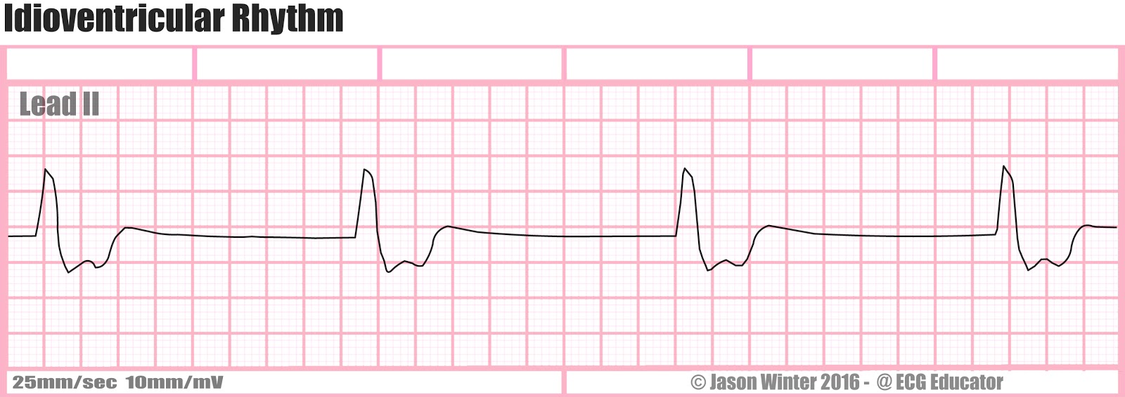 ECG Educator Blog : Six Second ECG Rhythm Strips