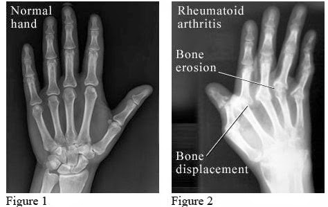 Rheumatoid Arthritis : X-Ray of Rheumatoid Arthritis(RA) in the Hands