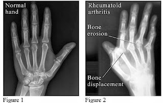 Rheumatoid Arthritis : X-Ray of Rheumatoid Arthritis(RA) in the Hands