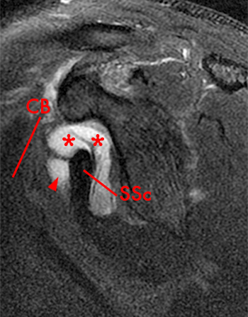 MRI Musculo-Skeletal Section: Coracoid bursa.