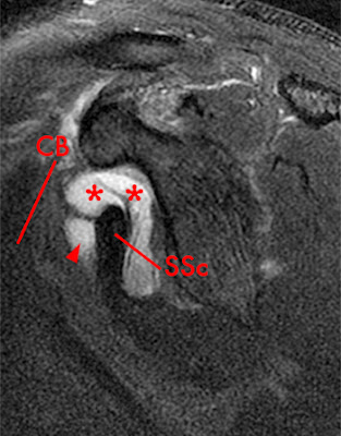 MRI Musculo-Skeletal Section: Coracoid bursa.