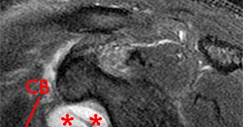 MRI Musculo-Skeletal Section: Coracoid bursa.