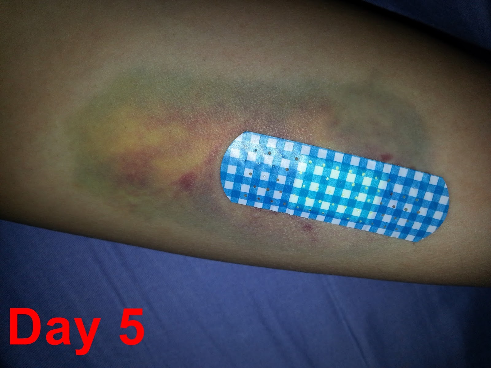 My experience with the birth control Implanon