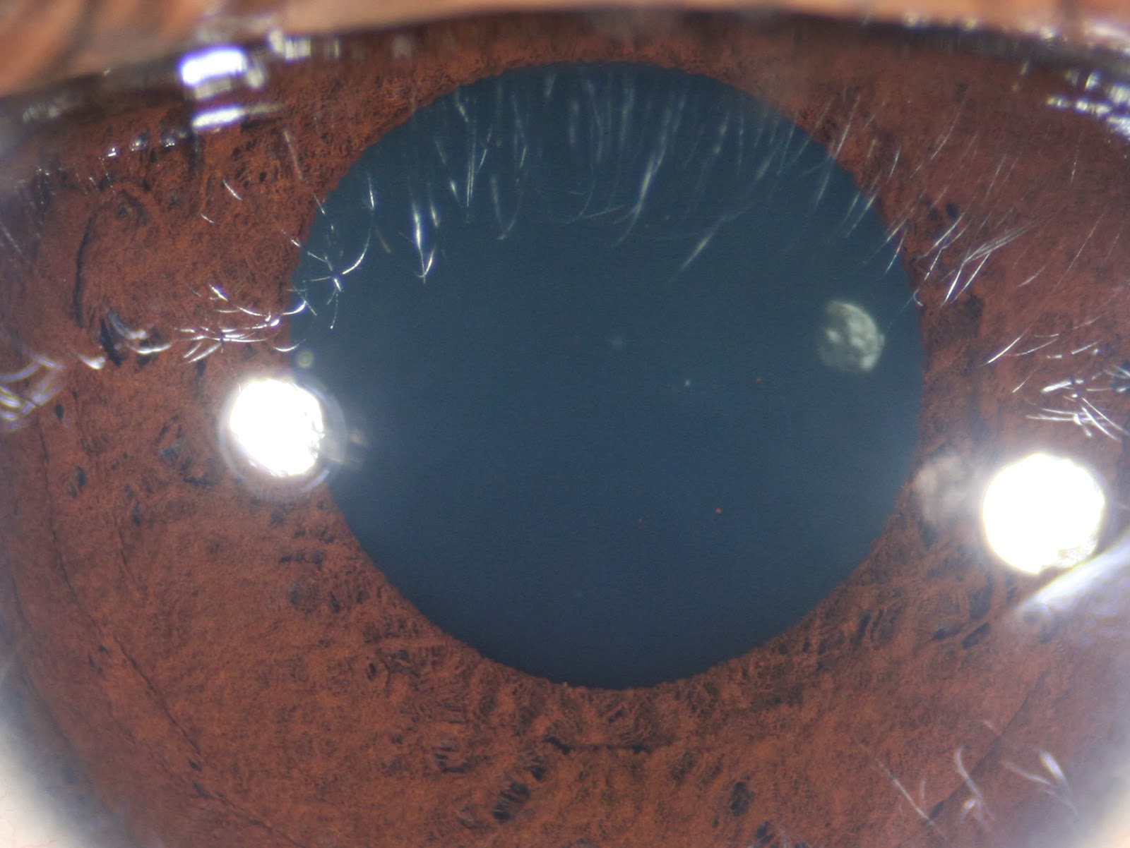Modern & Multidimensional Iridology: Signs at Internal Collarette ...