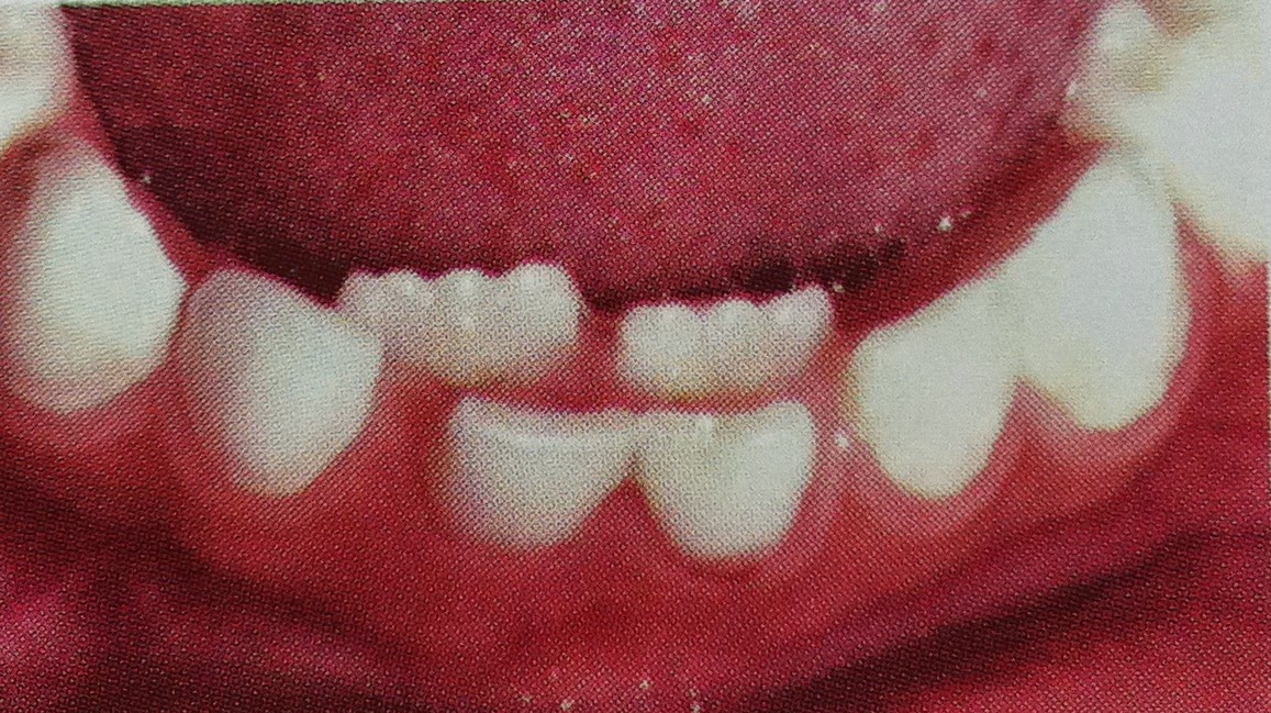 FAMILY CARE DENTAL: Replacement of Milk Teeth
