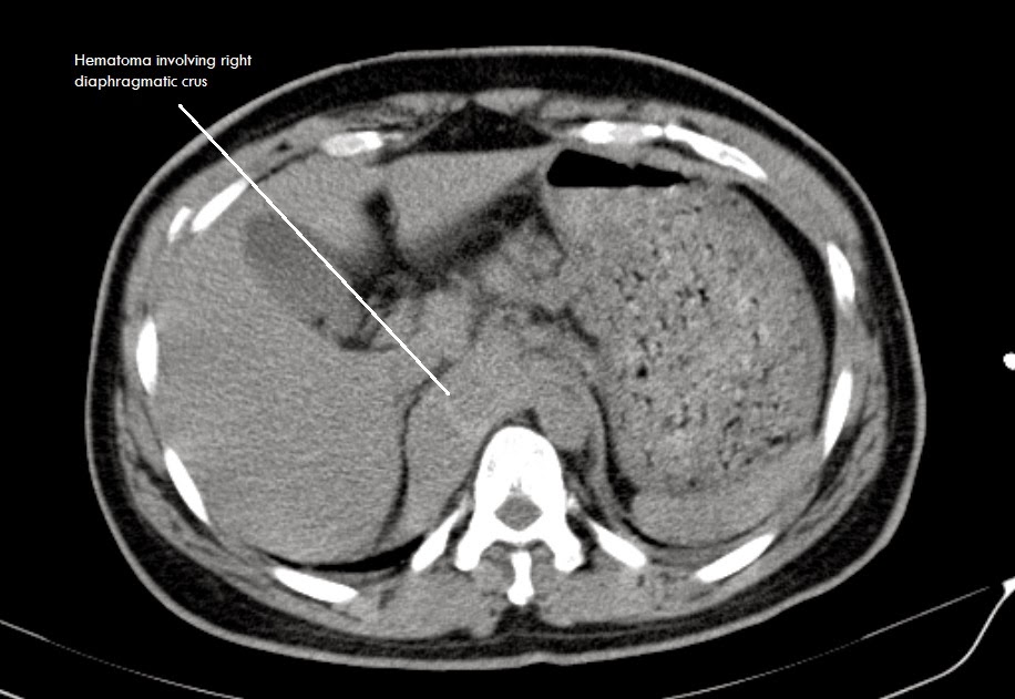 Ultimate Radiology : Active arterial extravasation in Blunt Abdominal ...