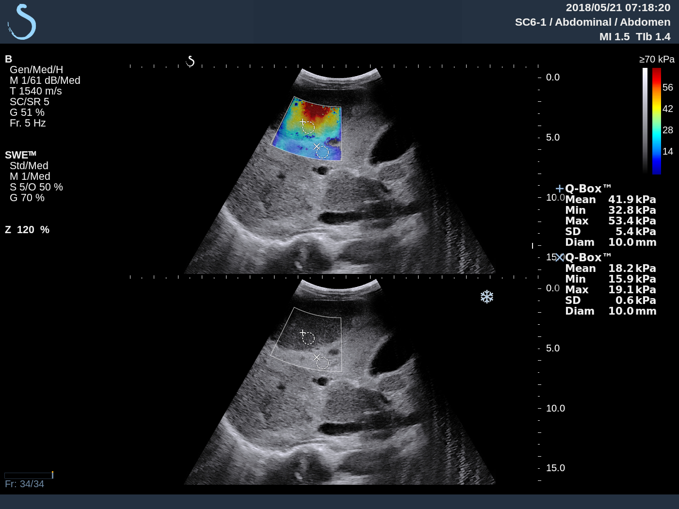 VIETNAMESE MEDIC ULTRASOUND: CASE 494: PRIMARY LIVER LYMPHOMA (PLL),Dr ...