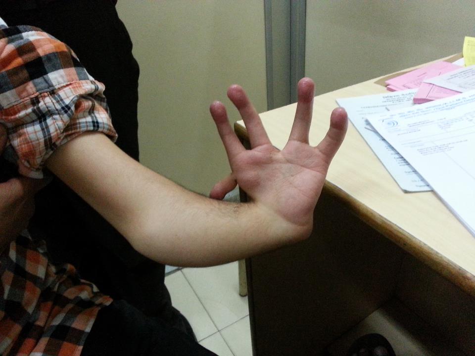 Holt Oram Syndrome Effect On Population