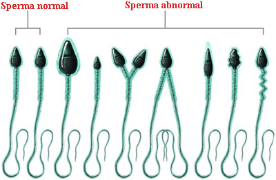 Penyebab dan Pengobatan Infertilitas pada Pria | Medkes