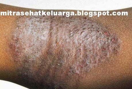 Contoh Obat Eksim Menahun