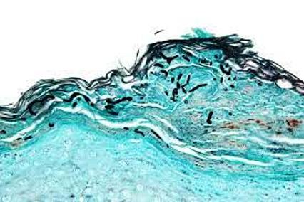 Dermatomikosis: Definisi, Penyebab dan Gambaran Klinis