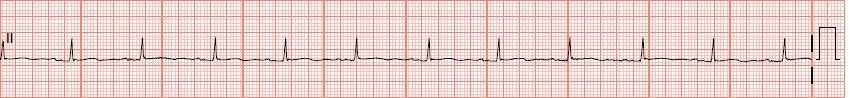EKG Rhythm Strip Quiz 52: Heart Blocks