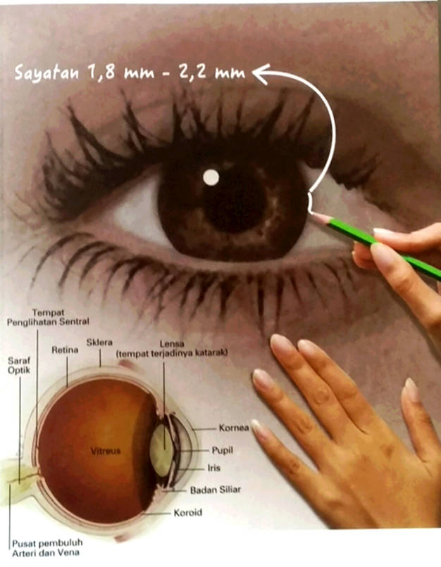 Informasi Tentang Katarak & Bladeless laser katarak