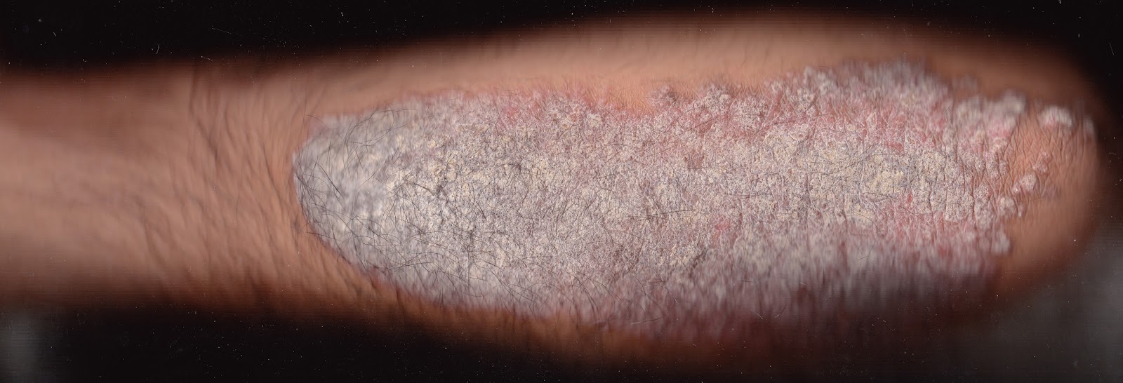 ¿Qué es la psoriasis?