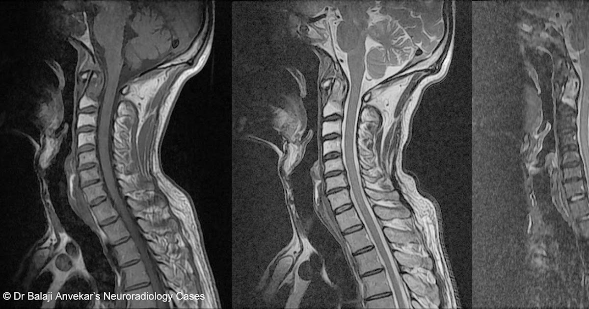 Neuroradiology Cases: Radiation Induced Bone Necrosis MRI