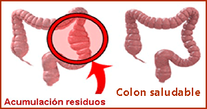 REMEDIOS PARA ALIVIAR EL COLON IRRITABLE | CONSEJOS DE LIMPIEZA, TRUCOS ...