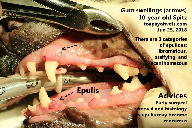 Does Epulis Have To Be Removed