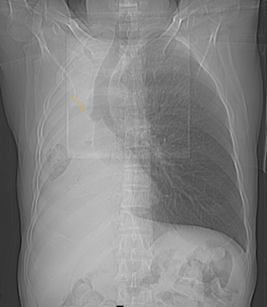 Bronchial Cut Off-CXR - Sumer's Radiology Blog