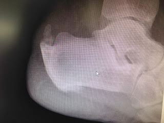 DR GALÁN - LESIONES DEPORTIVAS: SÍNDROME DE HAGLUND